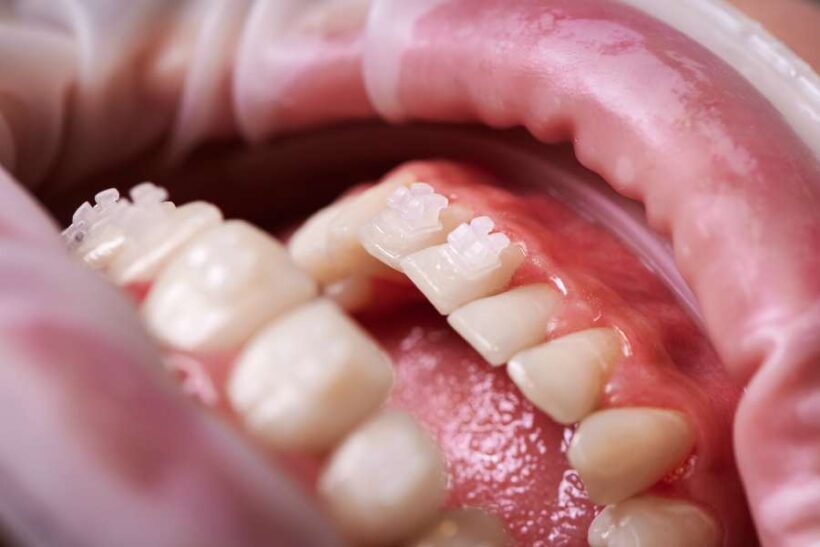 Koliko se nosi fiksna proteza? [Saveti + Iskustva] - MND Dental