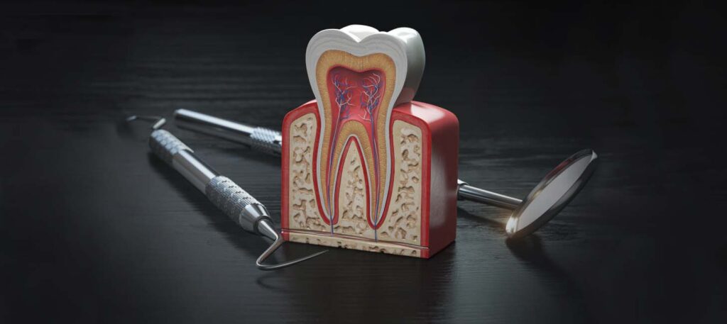 Gangrena Zuba - Kako nastaje i kako se leči? | MND Dental