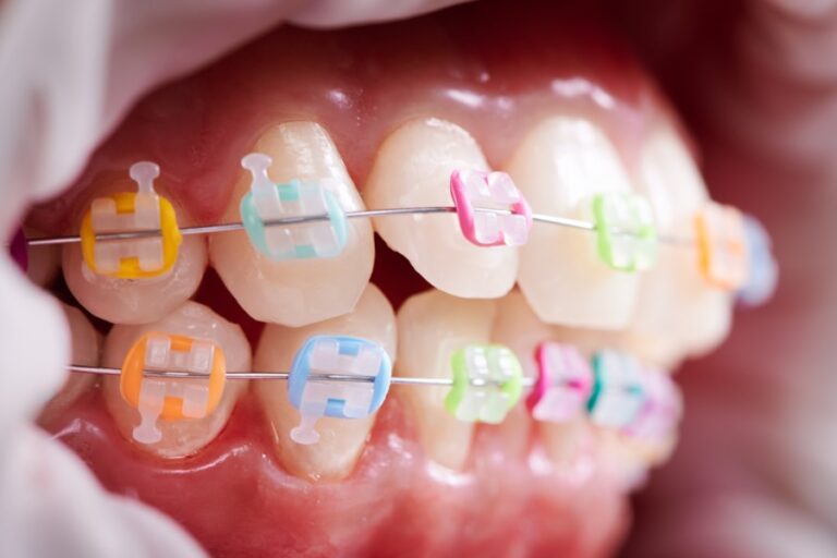 Fiksne Proteze - Cene i Vrste | MND Dental