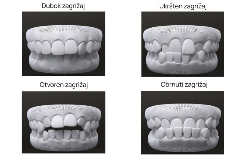 Nepravilan zagrižaj - Vrste, Uzroci i Rešenje | MND Dental